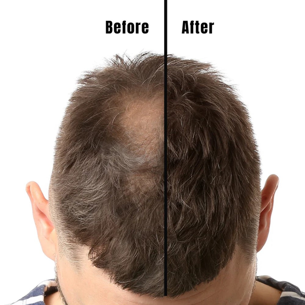 Procapil Hair Serum | Advanced Hair Growth & Hair Loss Solution ...